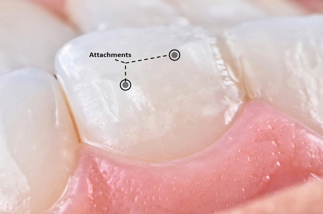 Attachments Est ticos Nos Alinhadores Invis veis Com Vittra APS FGM Attachments Est ticos Nos Alinhadores Invis veis Com Vittra APS FGM