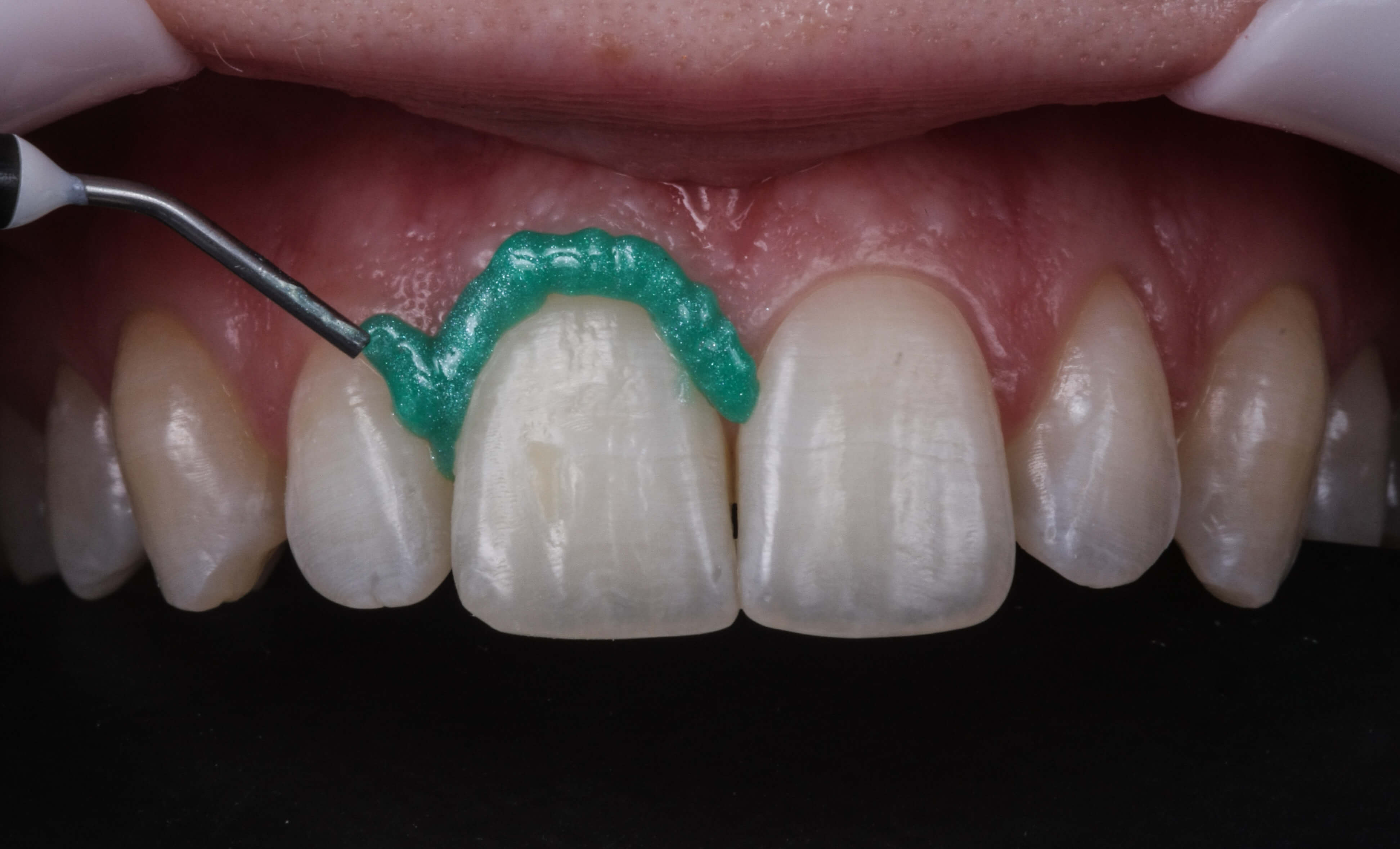 Barreira Gengival Top Dam