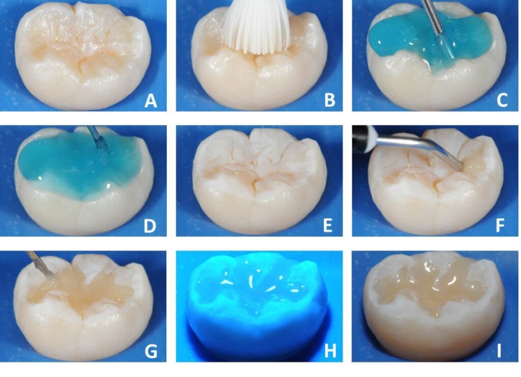 Protocolo clínico para aplicação do selante de fóssulas e fissuras ...