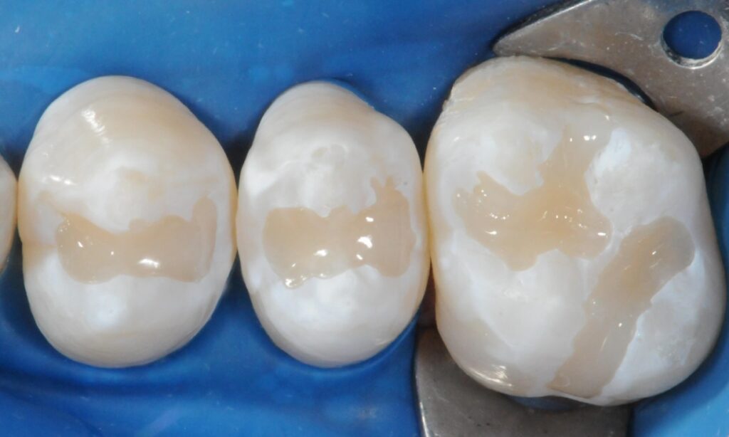 Clinical Protocol for Application of Pit and Fissure Sealant - FGM ...