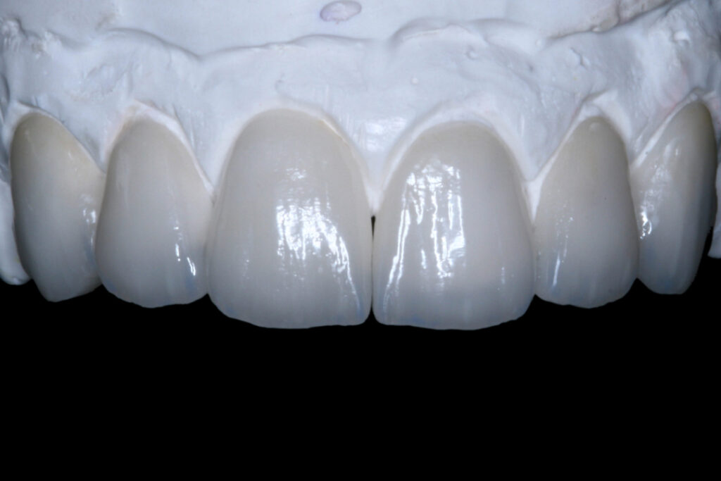 Facetas de cerâmica ou resina: descubra a diferença - FGM Dental Group