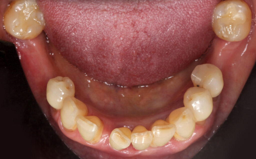Protocolo Inferior com Implantes HE - FGM Dental Group