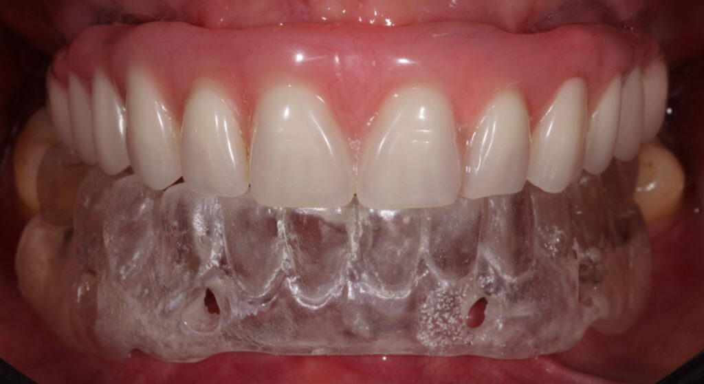 Protocolo Inferior con Implantes HE - FGM Dental Group