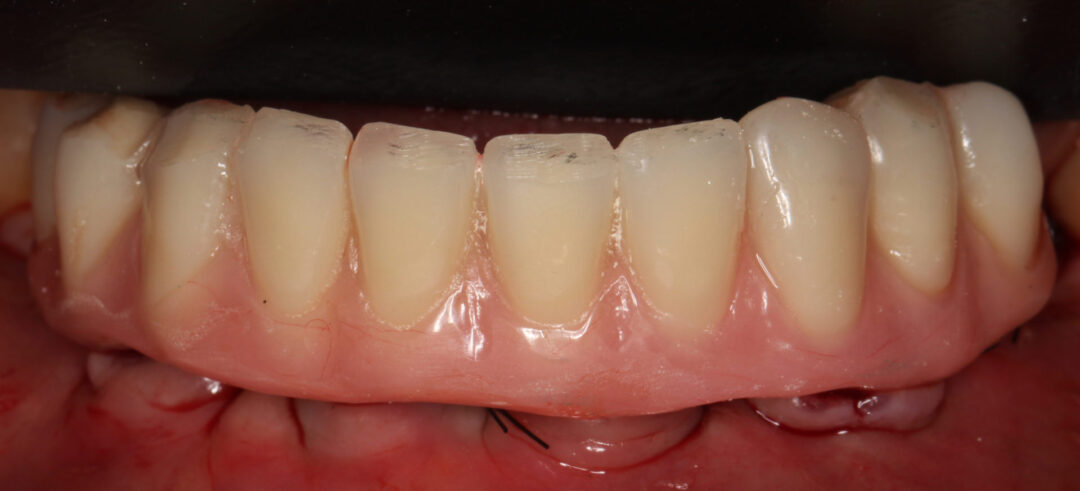 Protocolo Inferior com Implantes HE - FGM Dental Group