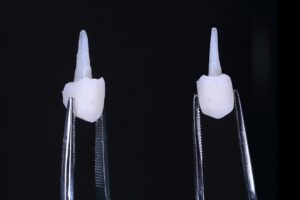 Postes en fibra de vidrio anatomizados: El paso a paso de la rutina ...