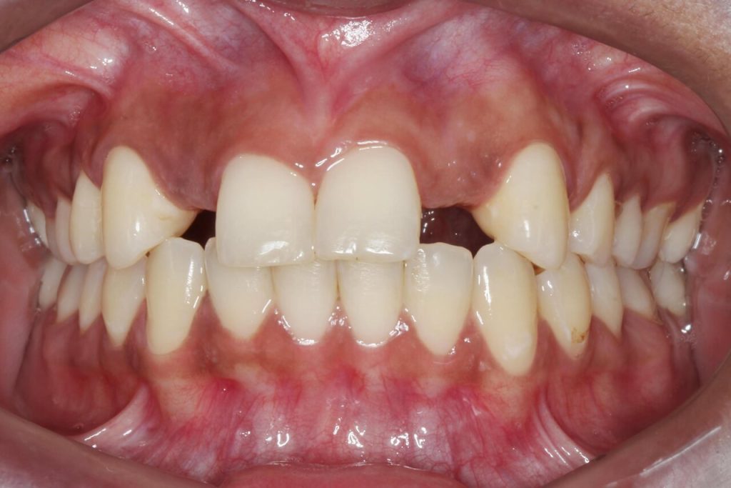 Bone reconstruction and implantations with prototyped guide in agenesia ...