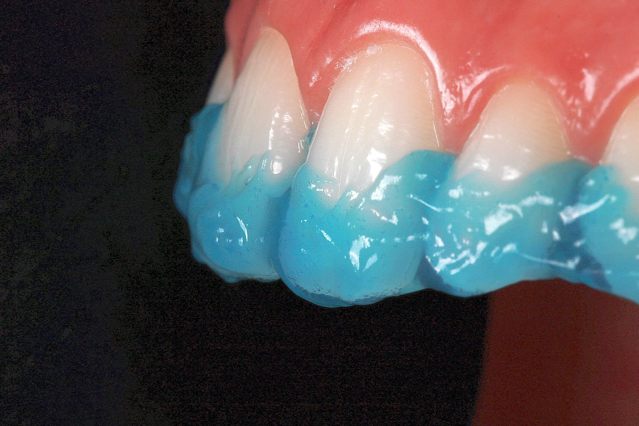 Anterior rehabilitation in composite resin with subsequent change of ...