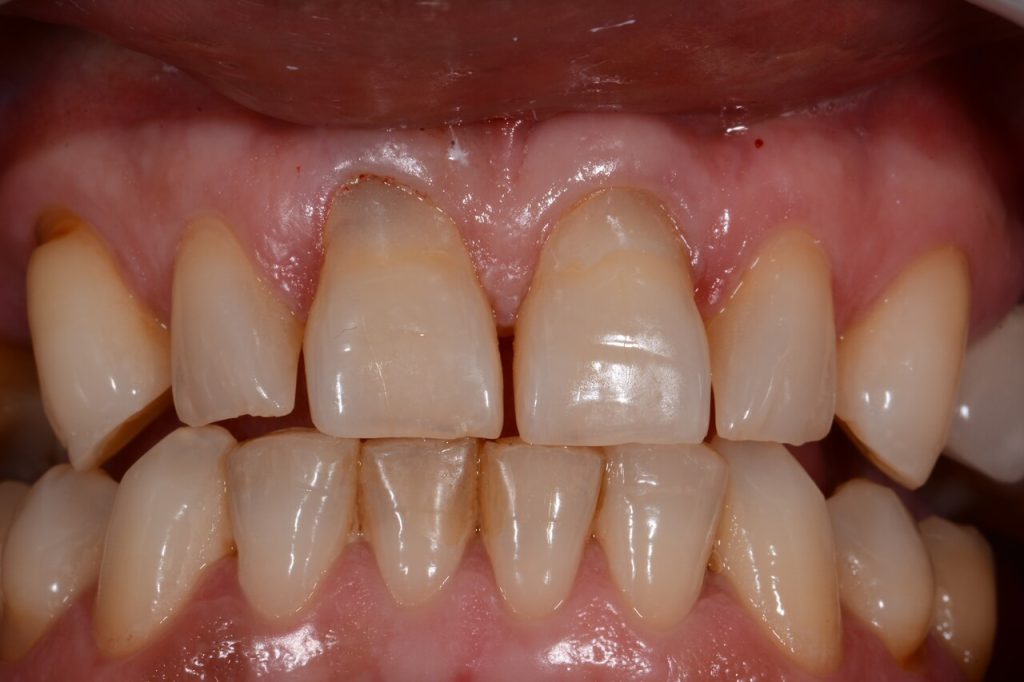 Class V cervical lesion restored with Vittra APS Unique Flow ...