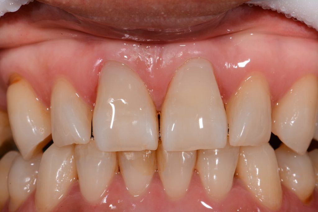 Class V cervical lesion restored with Vittra APS Unique Flow ...