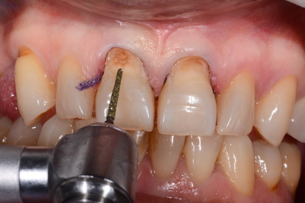 Class V cervical lesion restored with Vittra APS Unique Flow ...
