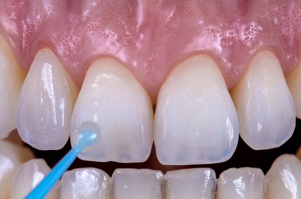 Application of Vittra APS Unique as an esthetic alternative for making ...