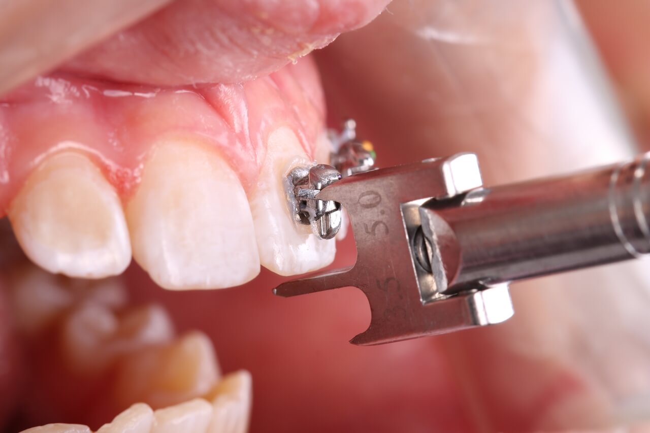 Adhesive devices complementary to orthodontic treatment: case report ...