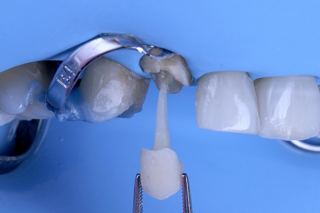 Anatomized fiberglass posts: the step-by-step - FGM Dental Group