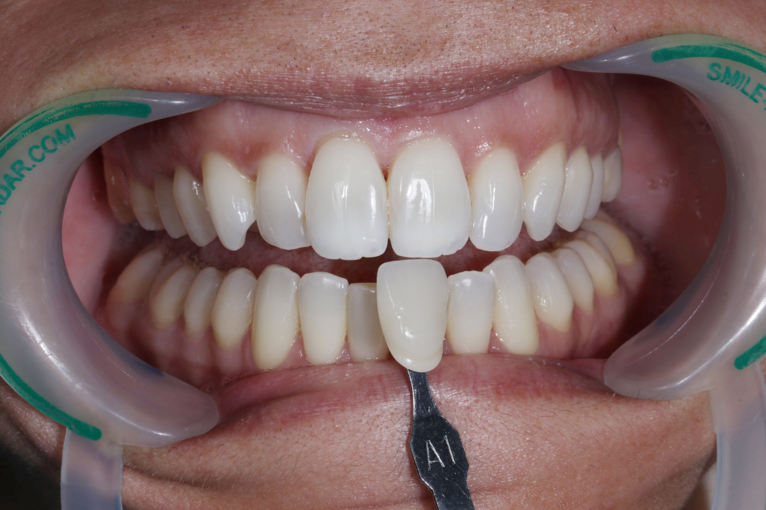 Complementary adhesive devices for orthodontic treatment - FGM Dental Group