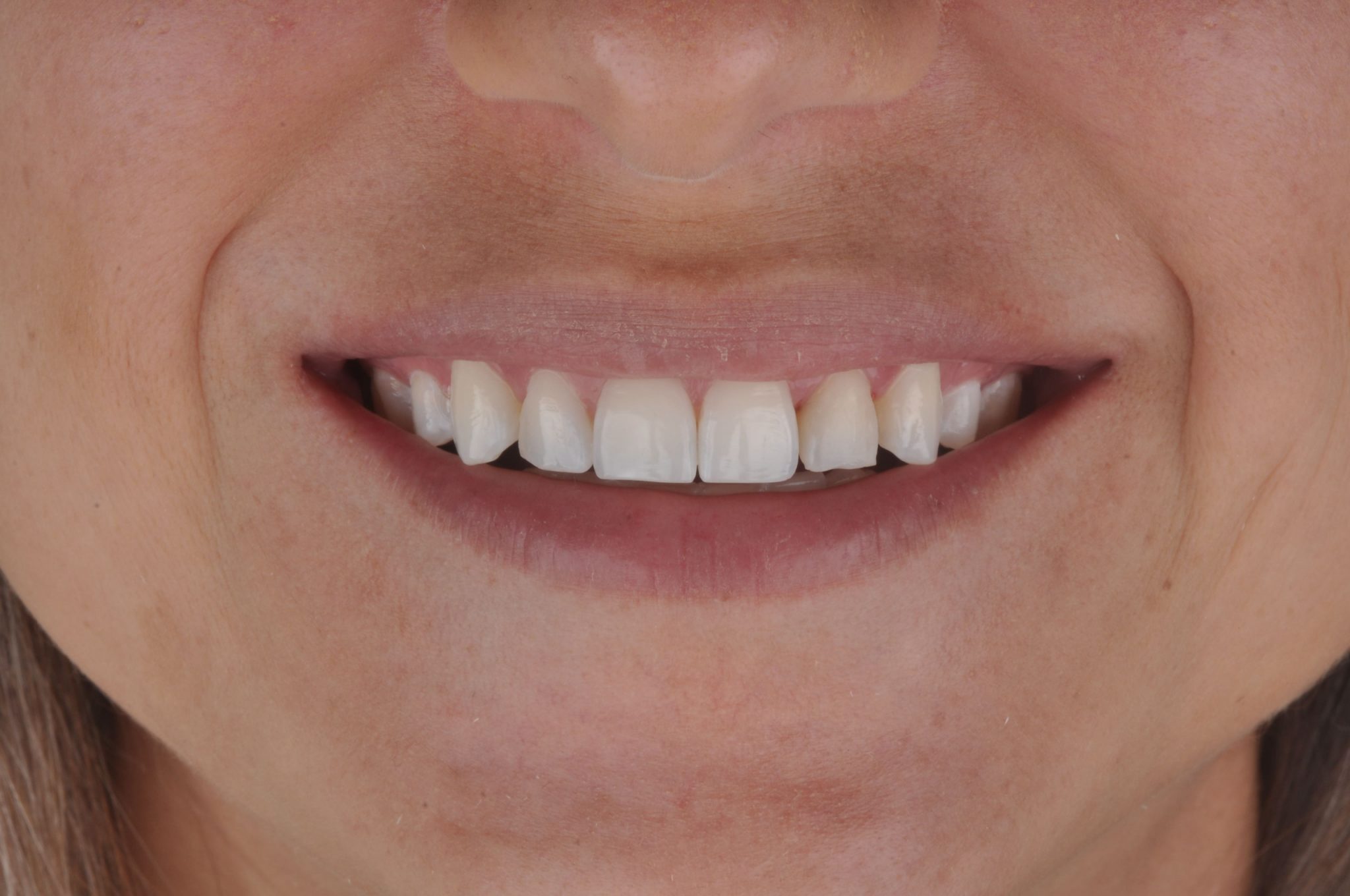 Resina Vittra APS: Facetas estéticas com as novas cores Bleach - FGM ...