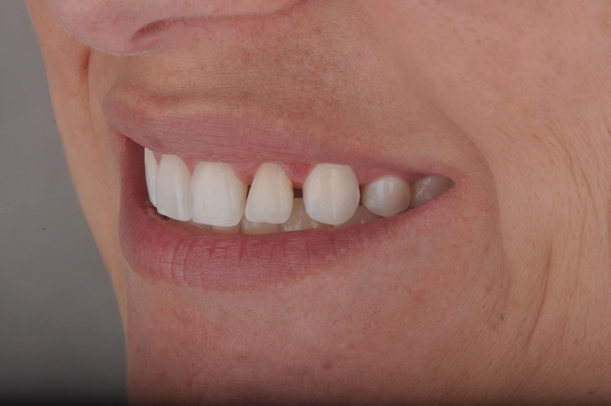 Resina Vittra APS: Facetas estéticas com as novas cores Bleach - FGM ...