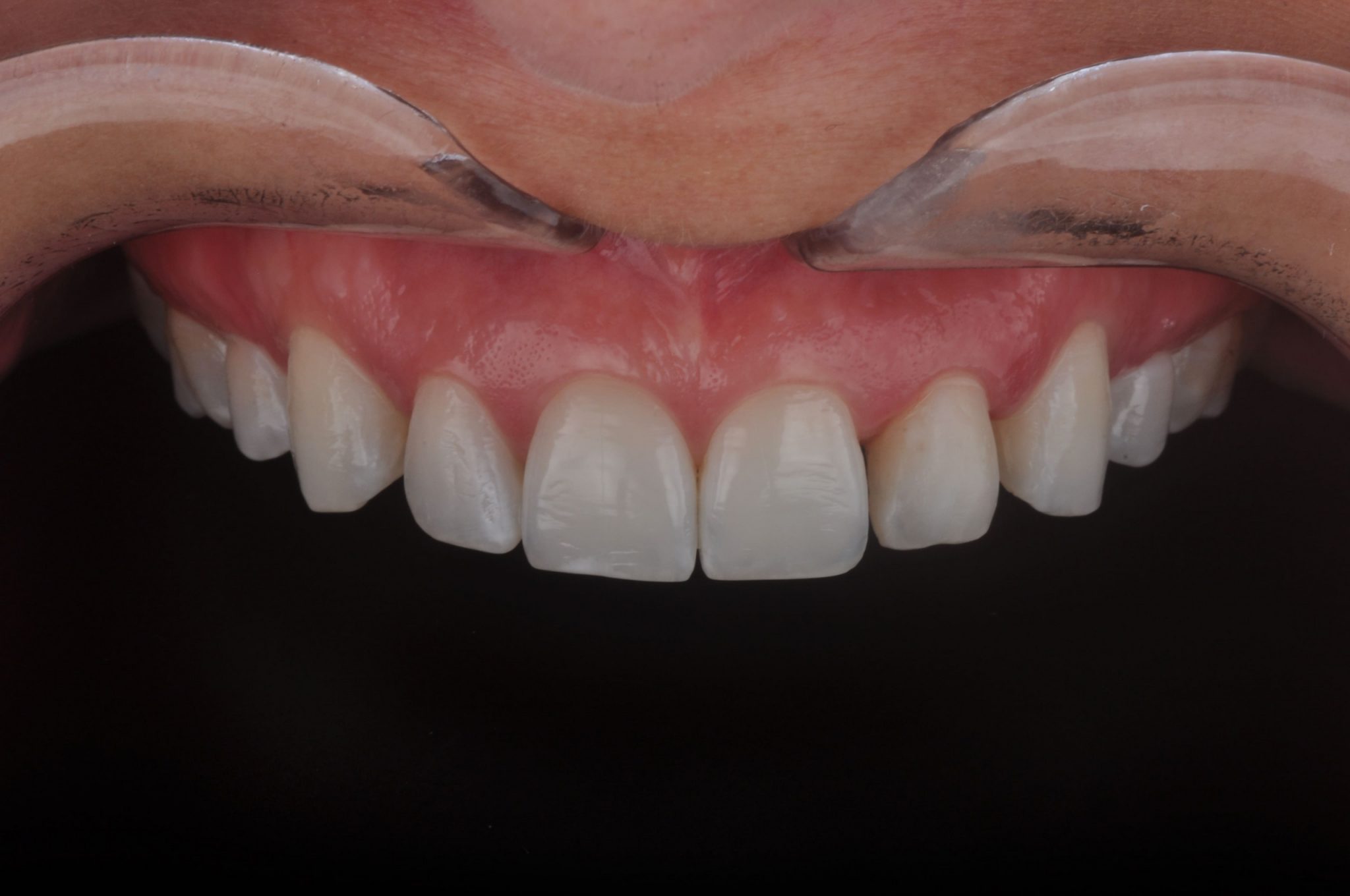 Resina Vittra APS: Facetas estéticas com as novas cores Bleach - FGM ...