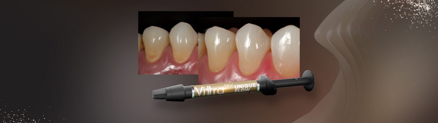 Direct Restoration of Non-Carious Cervical Lesions with Vittra APS ...