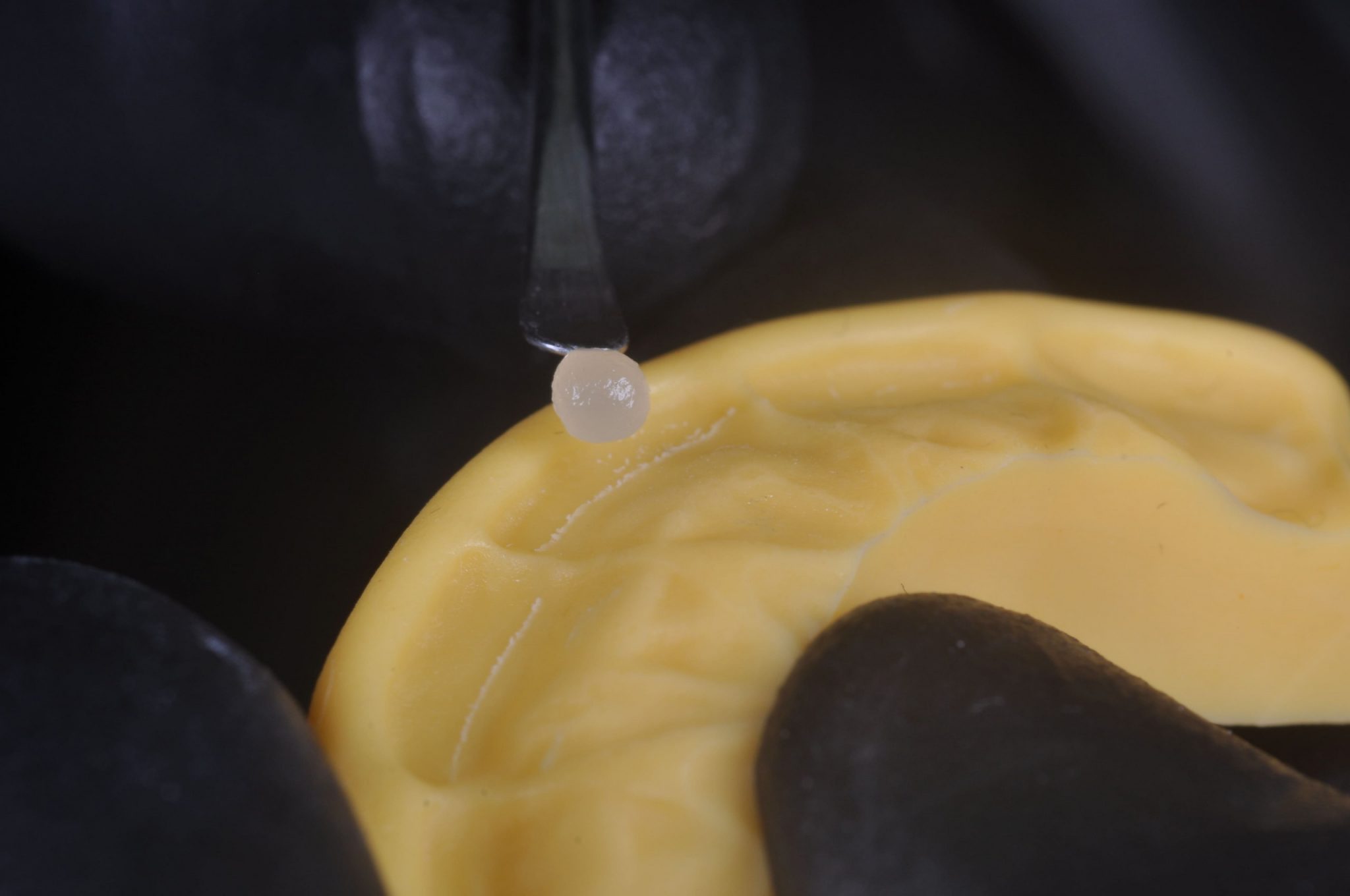 Resina Vittra APS: Facetas estéticas com as novas cores Bleach - FGM ...