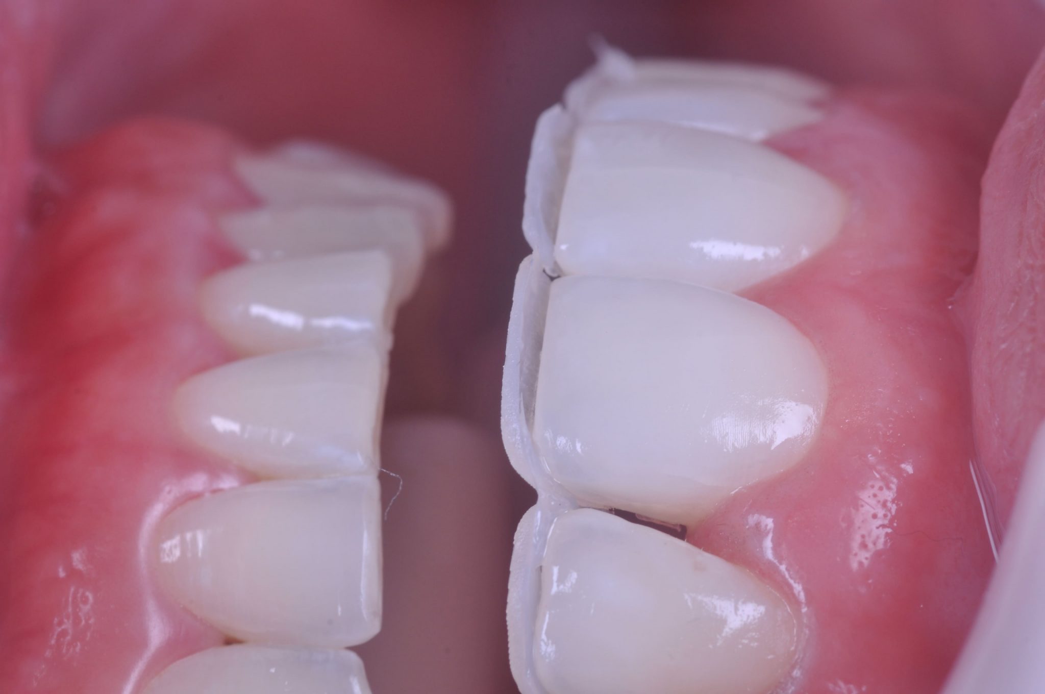 Resina Vittra APS: Facetas estéticas com as novas cores Bleach - FGM ...