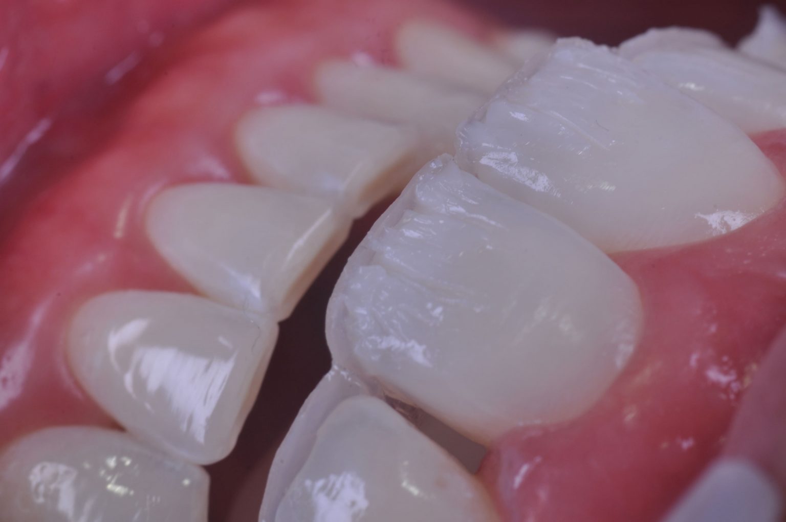 Resina Vittra APS: Facetas estéticas com as novas cores Bleach - FGM ...