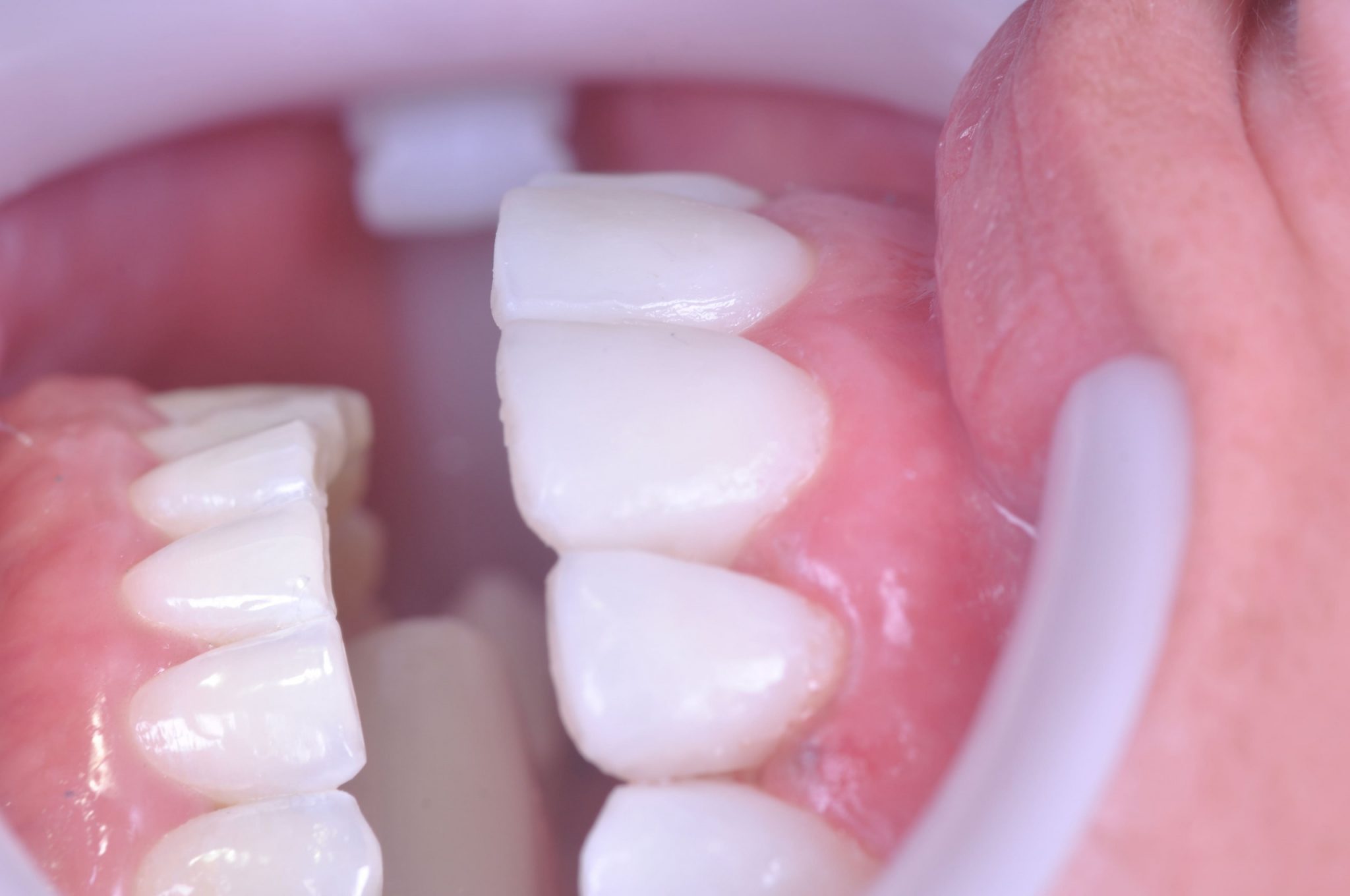 Resina Vittra APS: Facetas estéticas com as novas cores Bleach - FGM ...