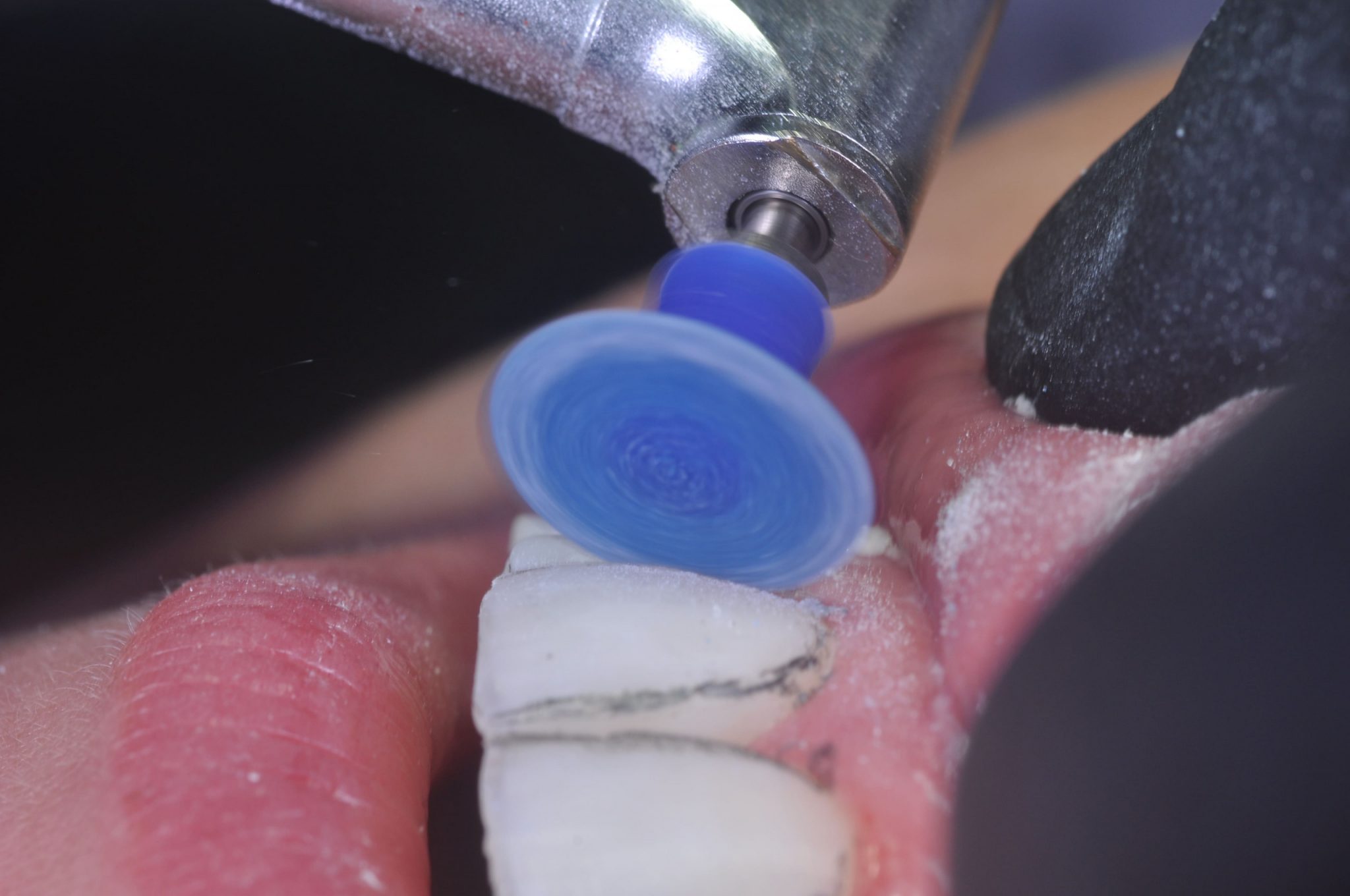 Resina Vittra APS: Facetas estéticas com as novas cores Bleach - FGM ...