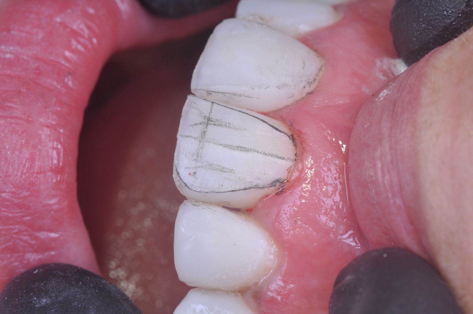 Resina Vittra APS: Facetas estéticas com as novas cores Bleach - FGM ...