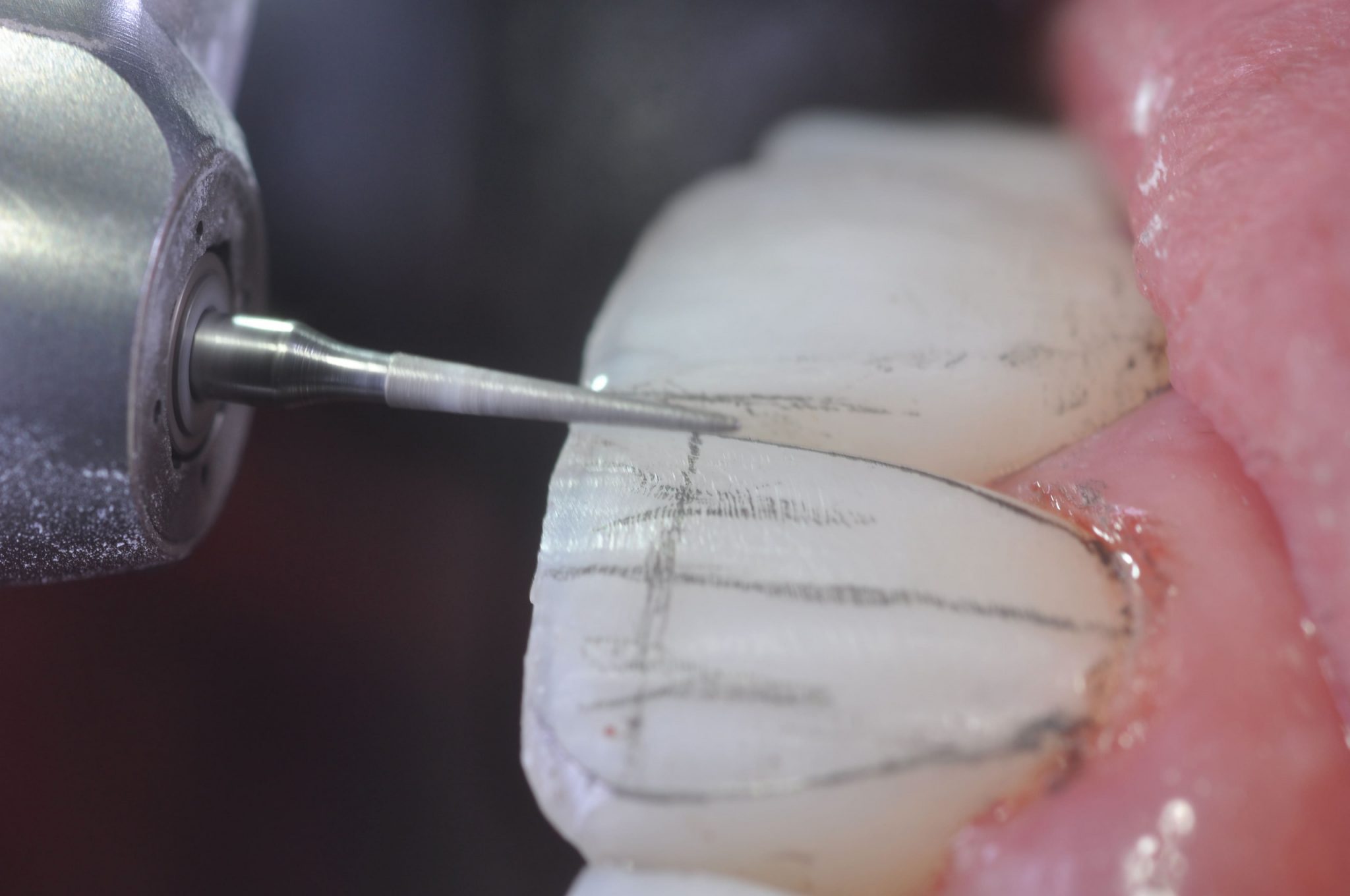 Resina Vittra APS: Facetas estéticas com as novas cores Bleach - FGM ...