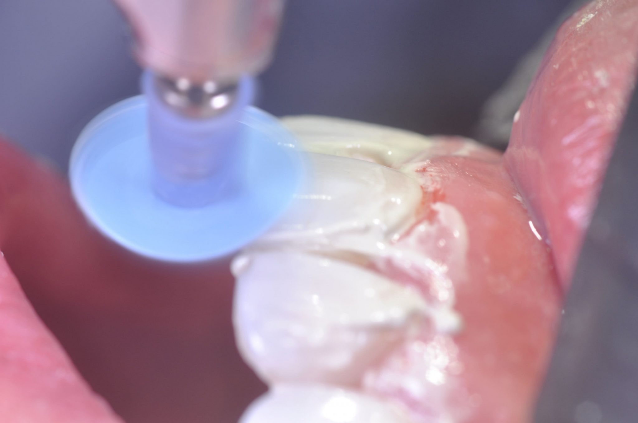 Resina Vittra APS: Facetas estéticas com as novas cores Bleach - FGM ...