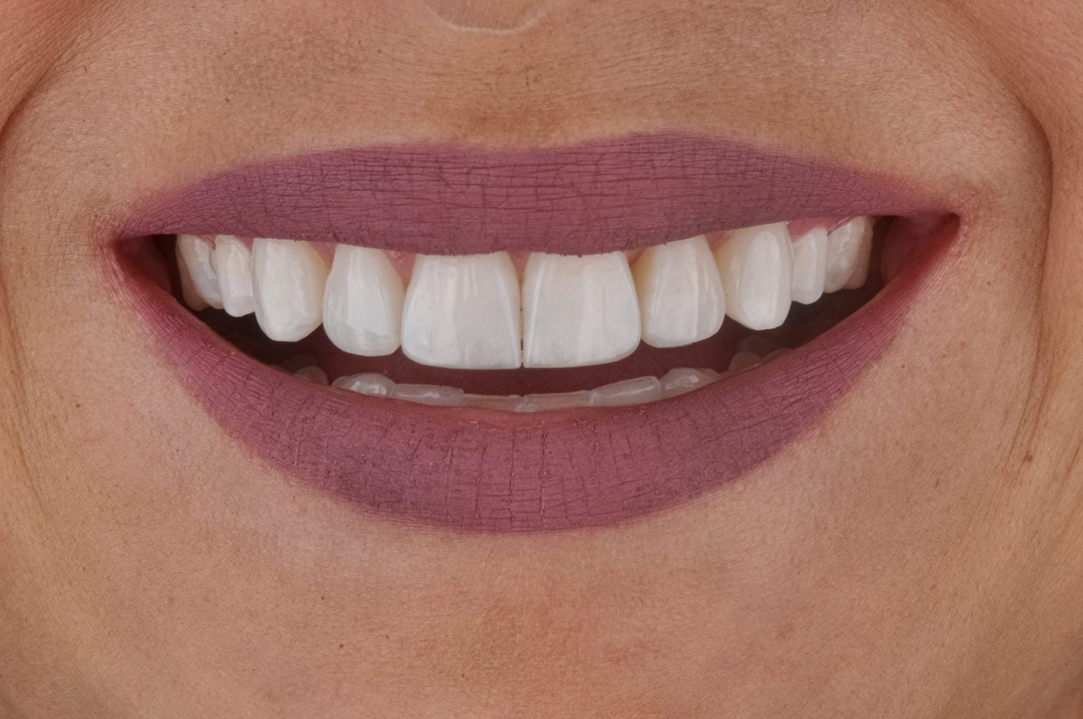 Resina Vittra APS: Facetas estéticas com as novas cores Bleach - FGM ...