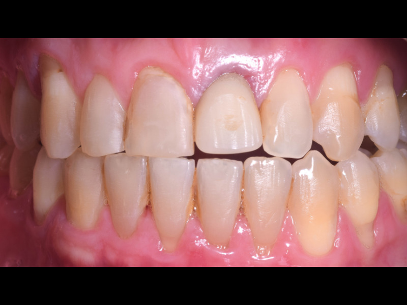 Case with extensive coronary destruction of the cervical region - FGM ...