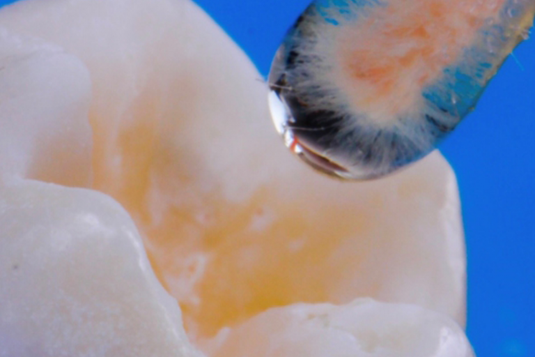 The importance of a correct adhesive application - FGM Dental Group
