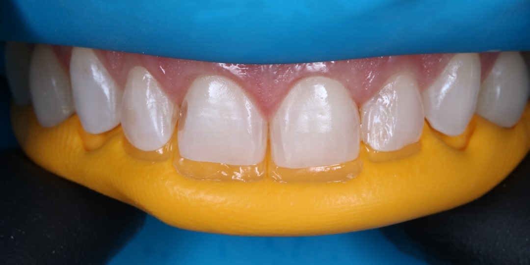 10 facetas superiores em resina Vittra APS - FGM Dental Group
