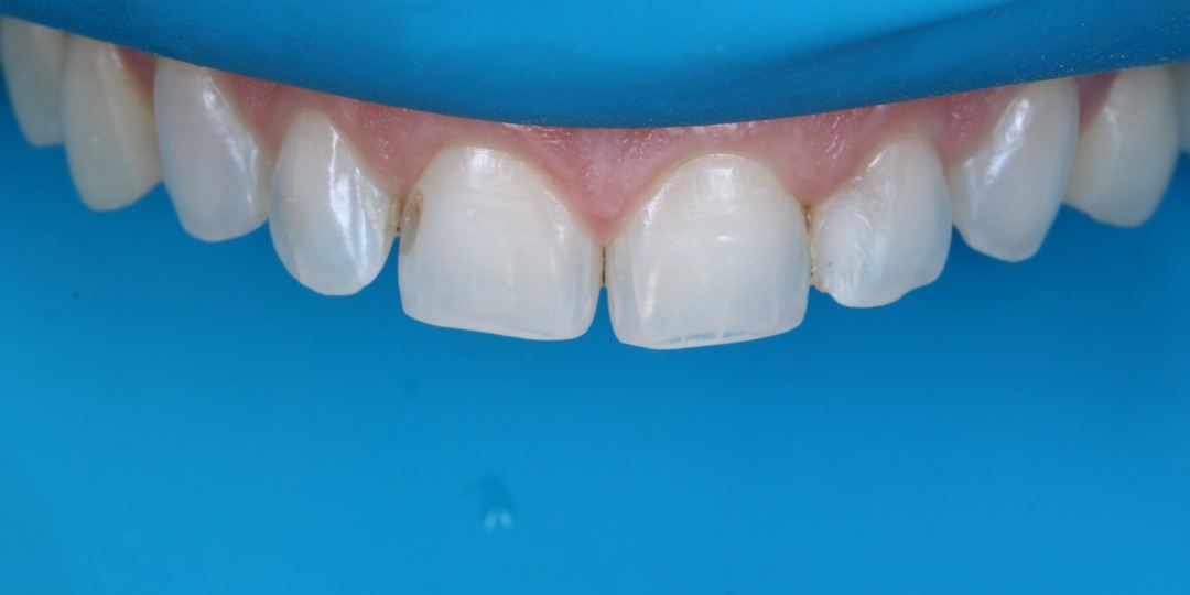 10 facetas superiores em resina Vittra APS - FGM Dental Group