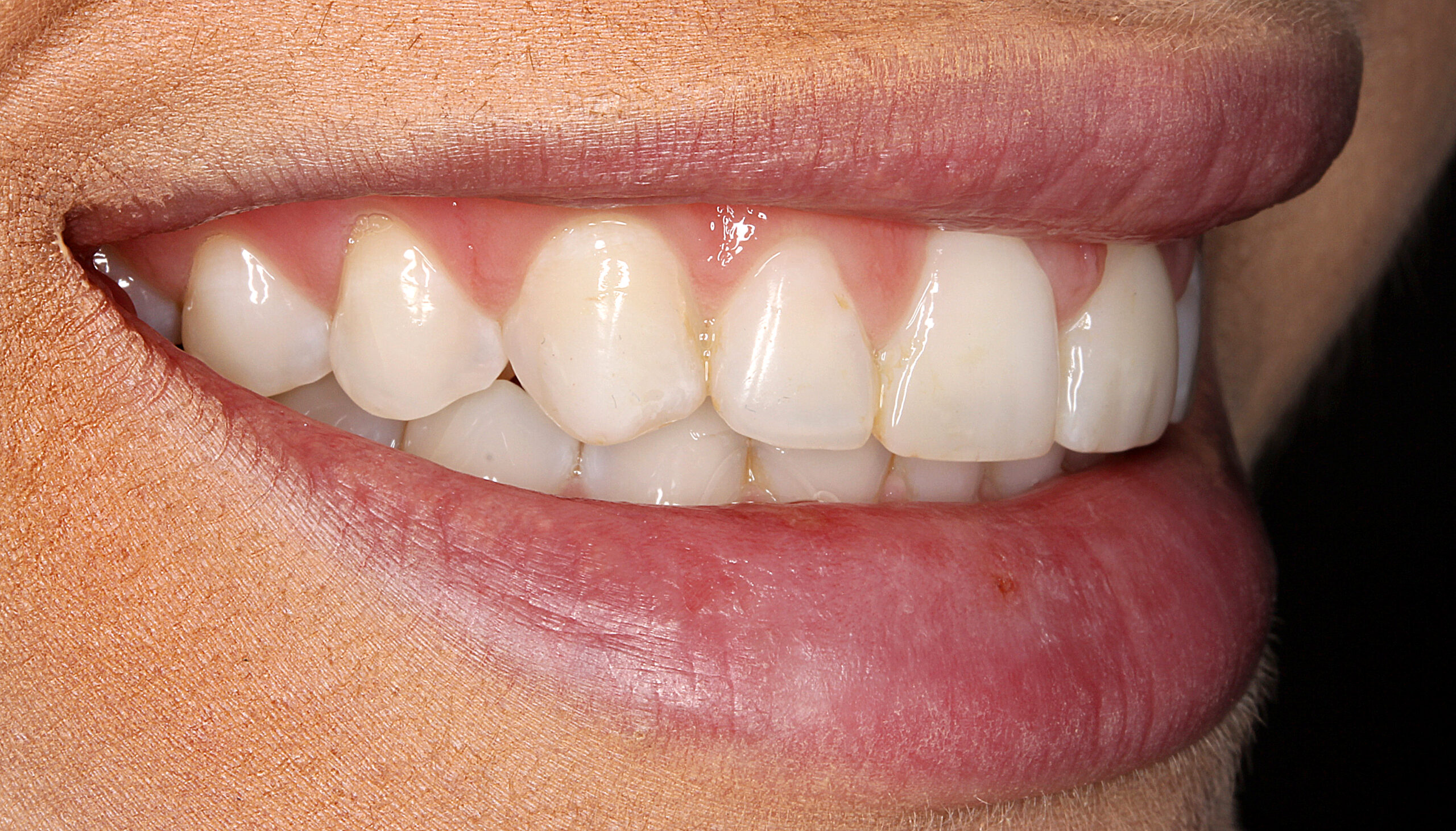 Bactérias do bem: como cuidar da flora que vive na boca - FGM Dental Group