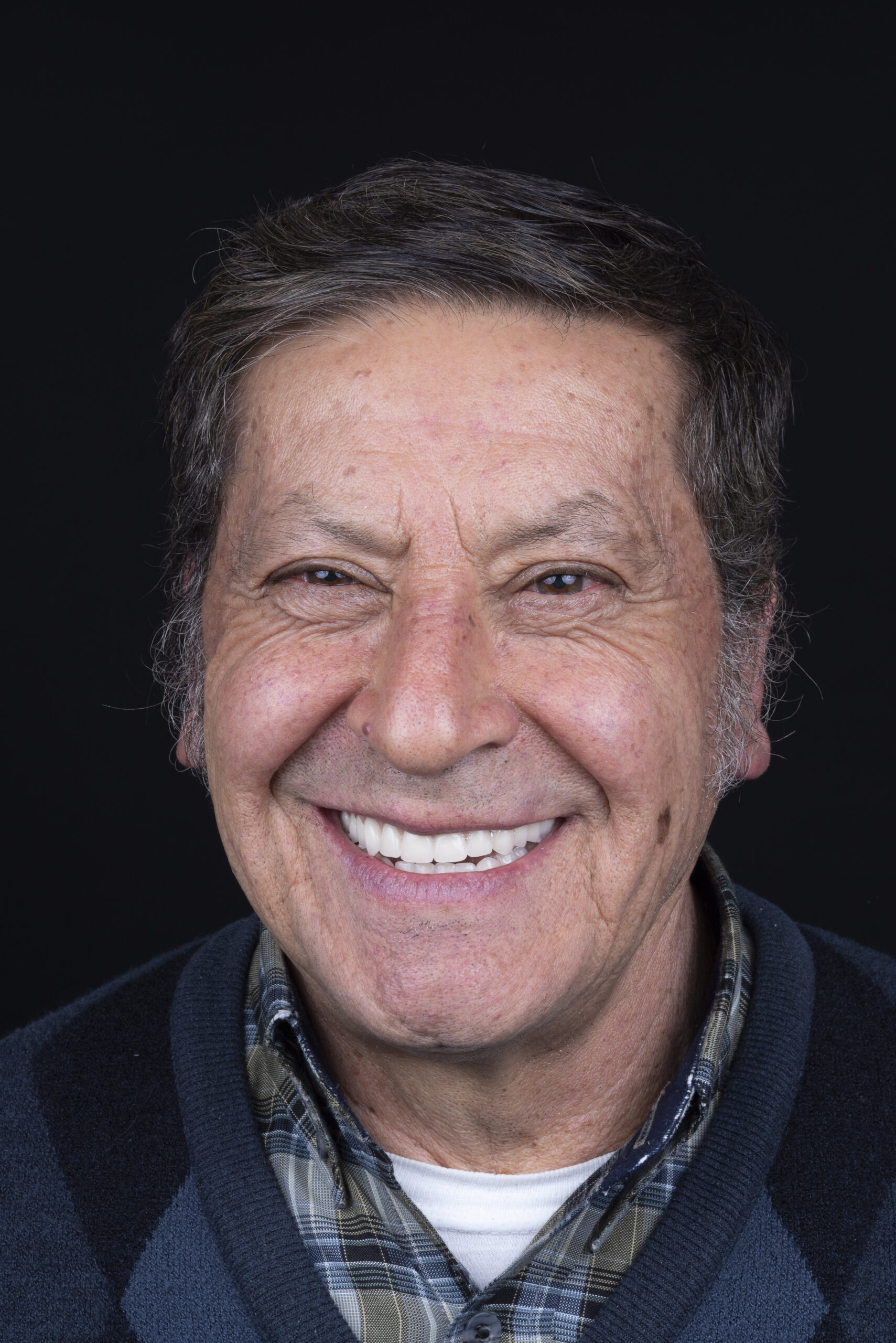 Smart overdenture on frictional implants - FGM Dental Group