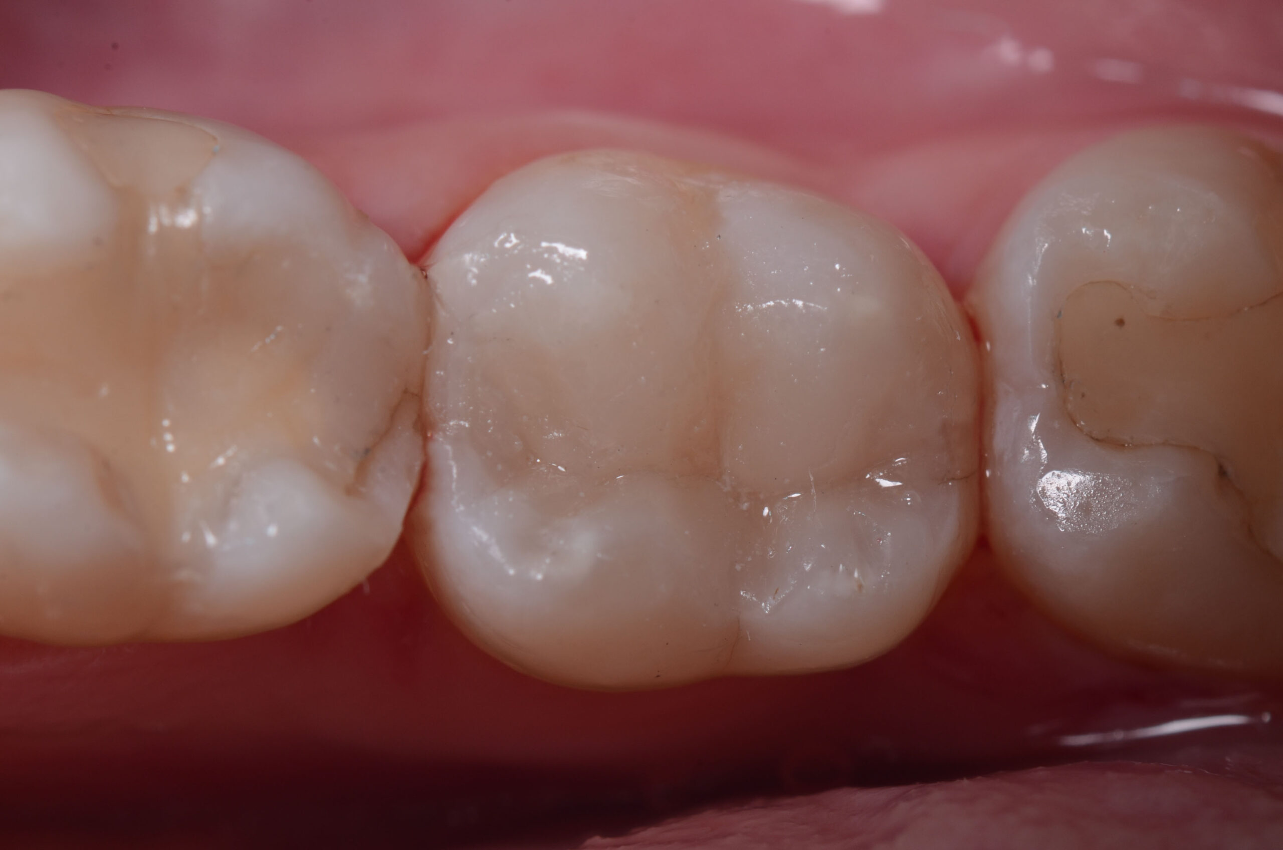 Use Of Vittra Aps Unique Universal Chroma Composite To Replace An ...