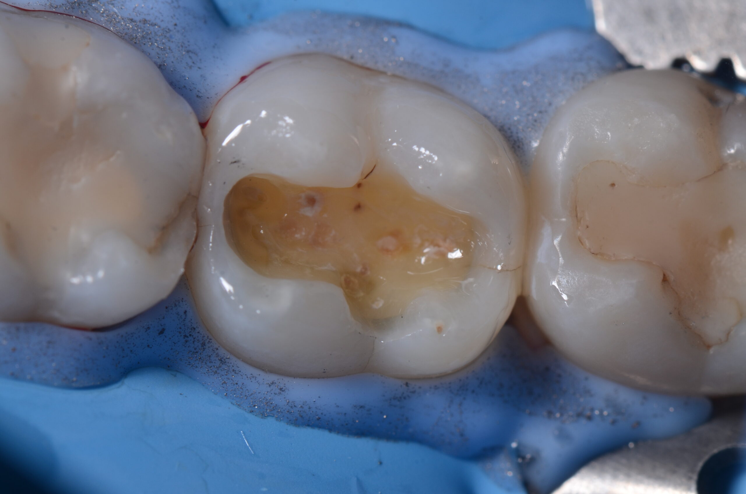 Use Of Vittra Aps Unique Universal Chroma Composite To Replace An ...