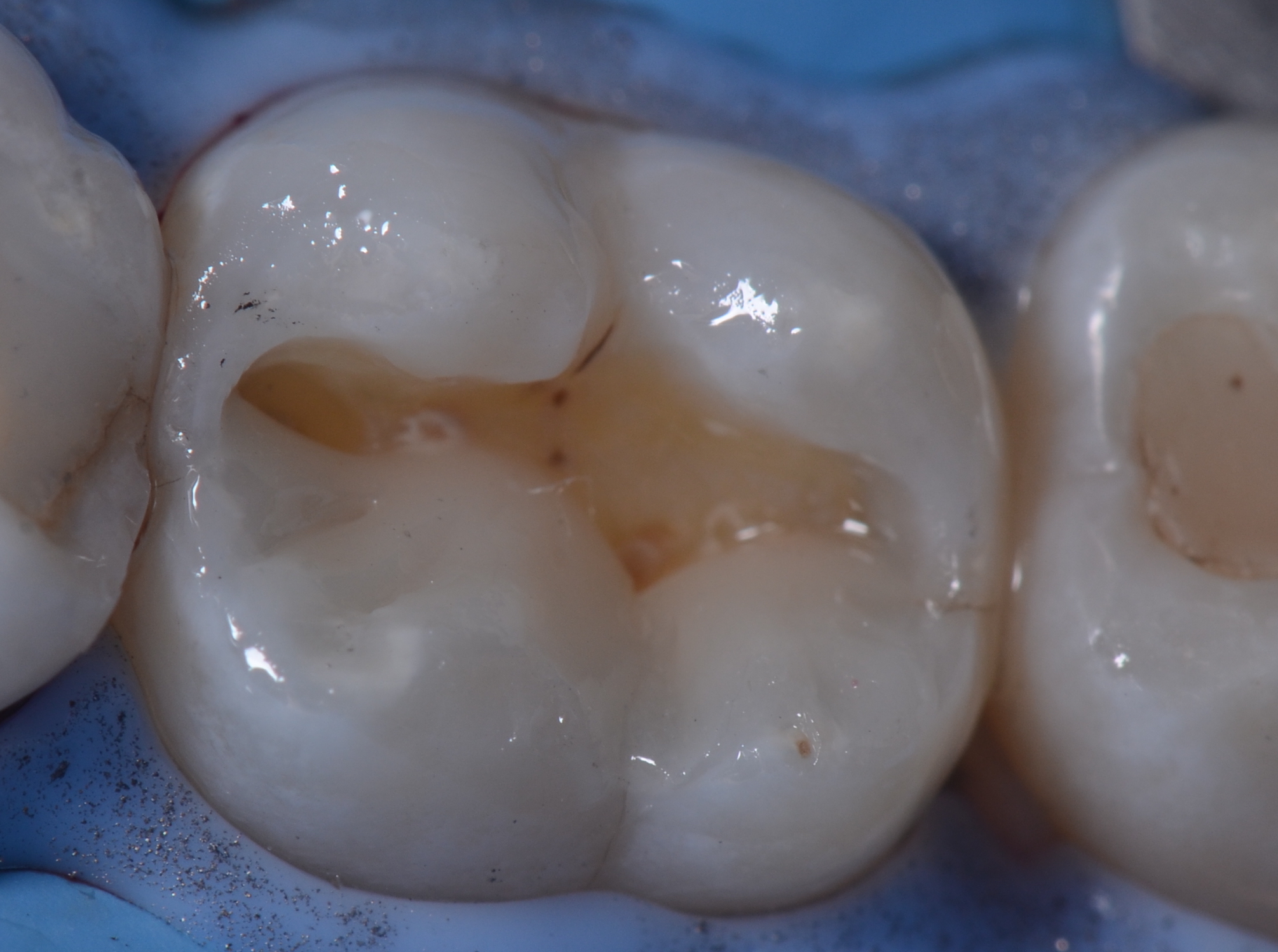 Use Of Vittra Aps Unique Universal Chroma Composite To Replace An ...