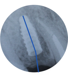 Arcsys Implant System | FGM Dental Group