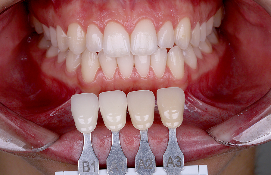 Blanqueamiento Dental Con T cnica Asociada Blanqueamiento Dental Con T cnica Asociada