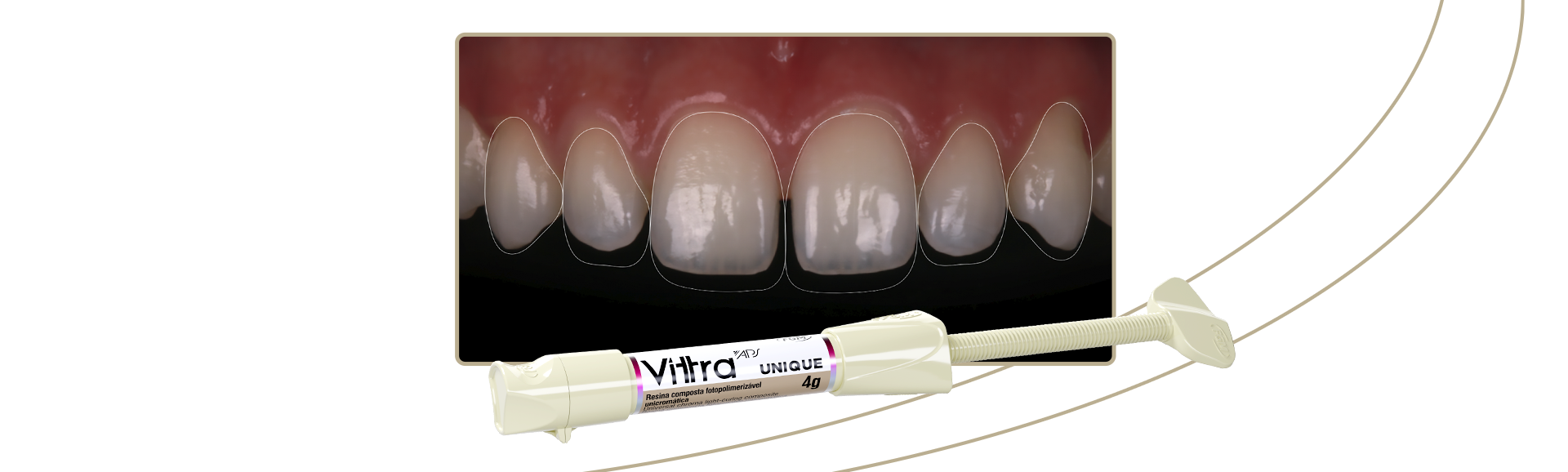 Como escolher a melhor resina para seu procedimento dental? - FGM ...