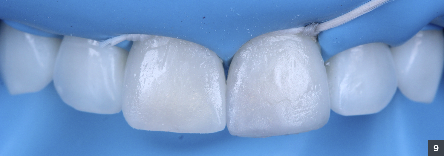 Vittra APS - Resina compuesta premium - FGM Dental Group