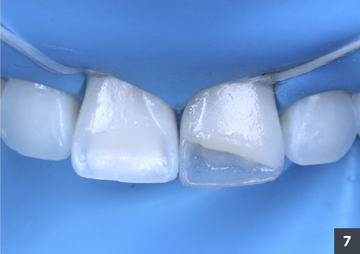 Vittra APS - Resina compuesta premium - FGM Dental Group