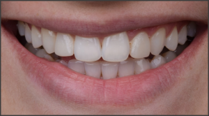 Cimento resinoso Allcem Veneer APS | FGM Dental Group