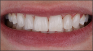 Cimento resinoso Allcem Veneer APS | FGM Dental Group