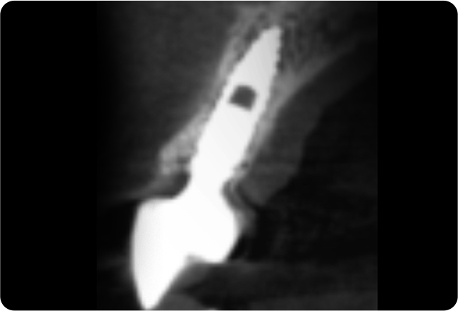 Arcsys Implant System | FGM Dental Group