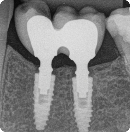 Sistema De Implantes Arcsys Fgm Dental Group