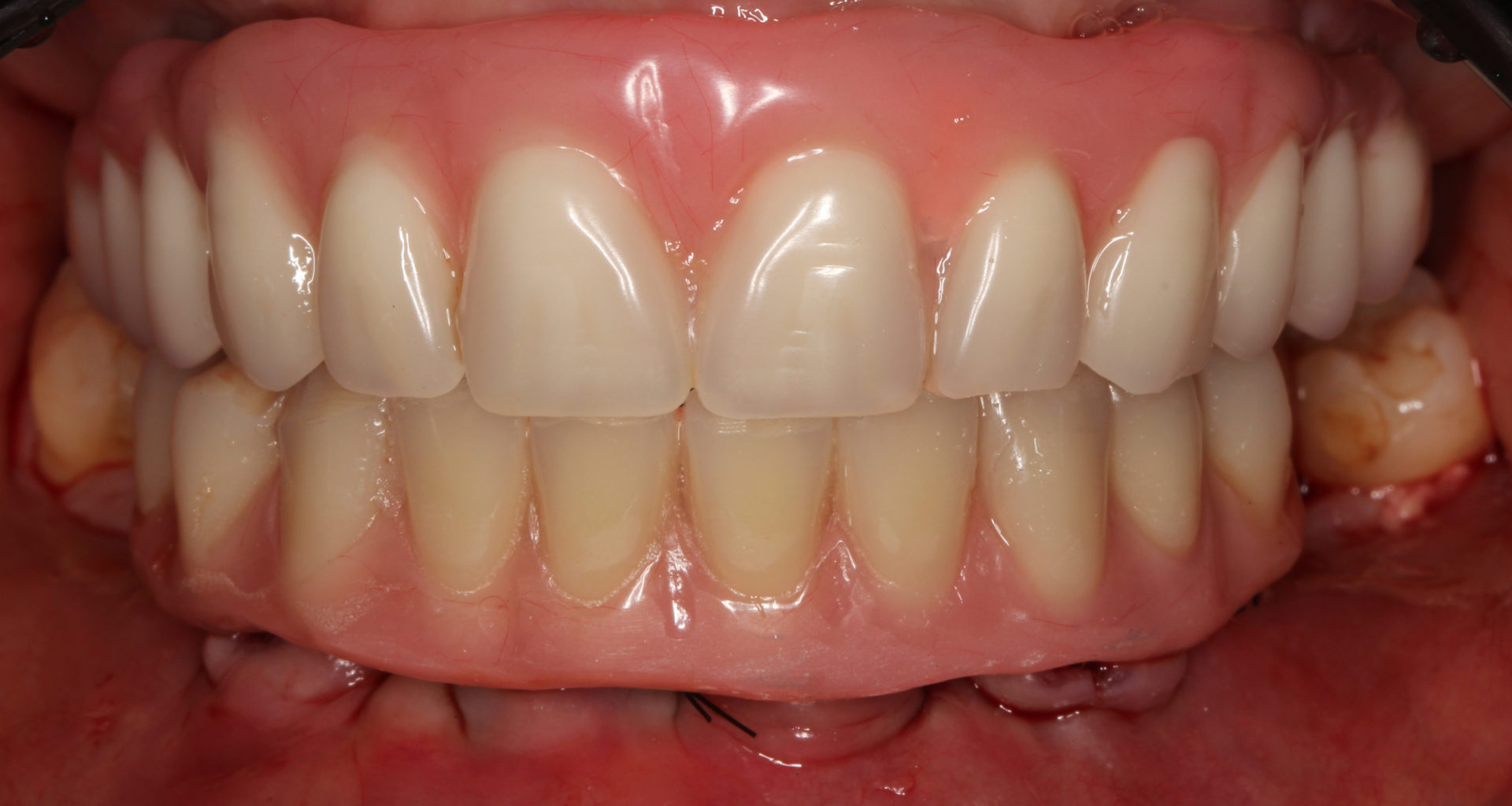 Prótese “protocolo” com Implantes HE - FGM Dental Group